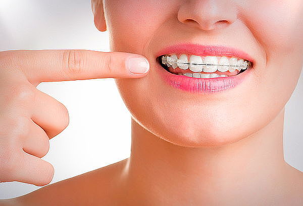 Instalación de Frenillos Metálicos, Providencia, Frenillos | Cuponatic.com