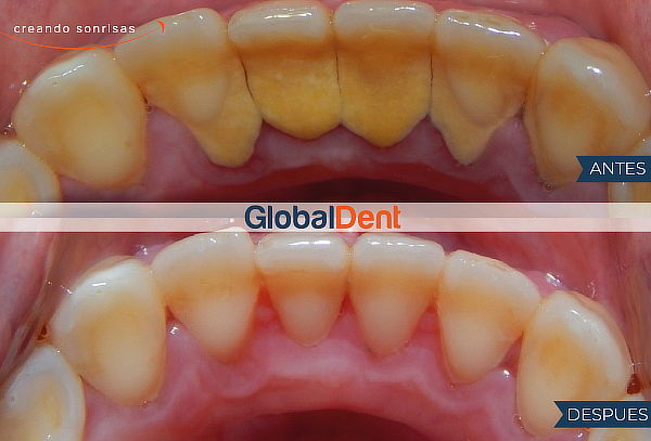 Detartraje + Pulido Radicular + Profilaxis con | Cuponatic