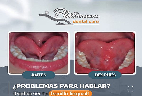 Cirugía de frenillo lingual de 7 años a mas | Cuponatic